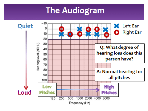 Understanding the Audiogram | Arizona Hearing Specialists